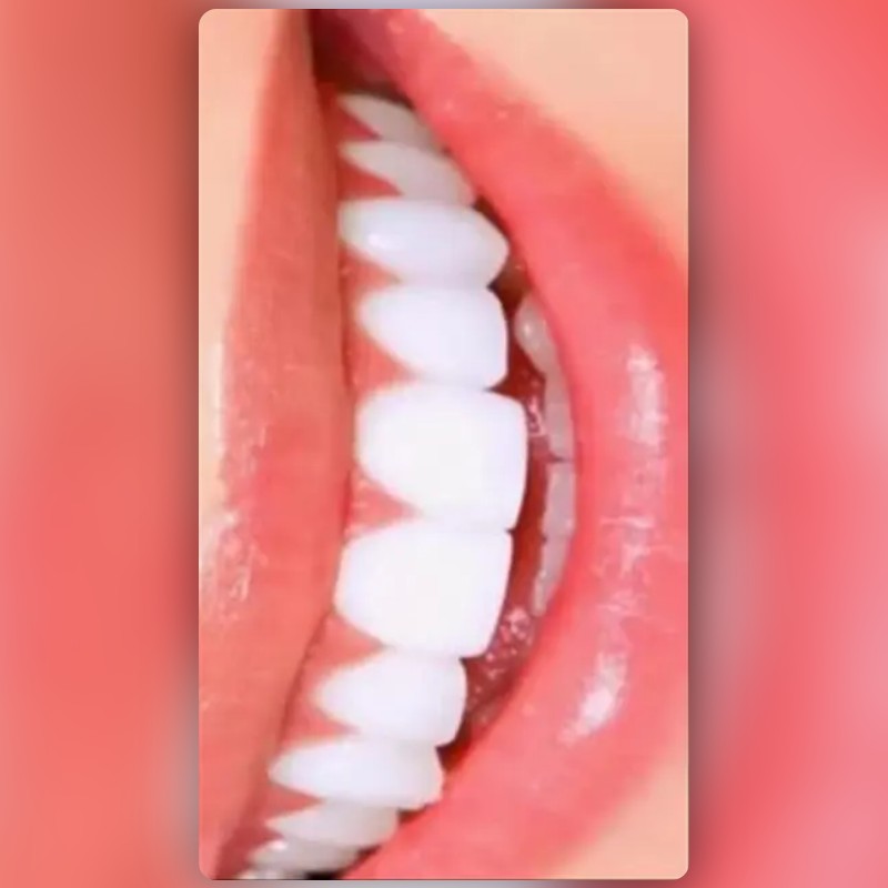 white teeth Lens by عــــدولـــــ - Snapchat Lenses and Filters