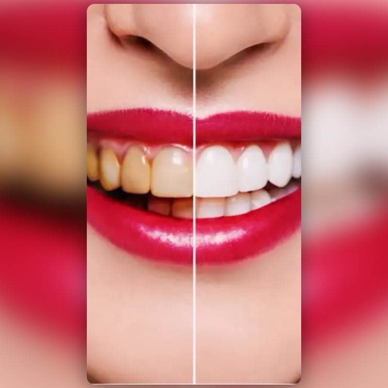 Teeth Filter by Ayob Sabri | Snapchat Lenses